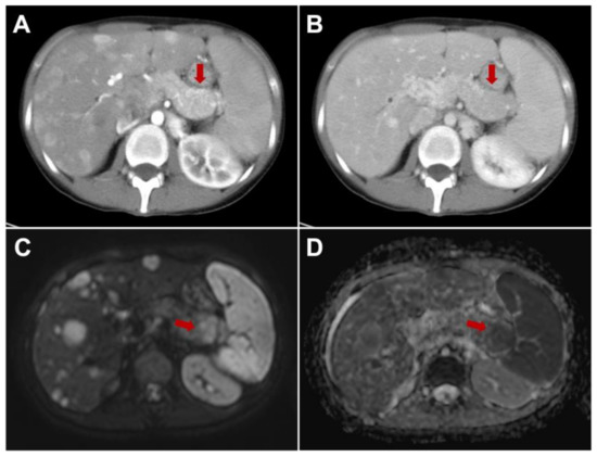 Nuclear Medicine and Radiological Imaging of Pancreatic Neuroendocrine Neoplasms: A ...