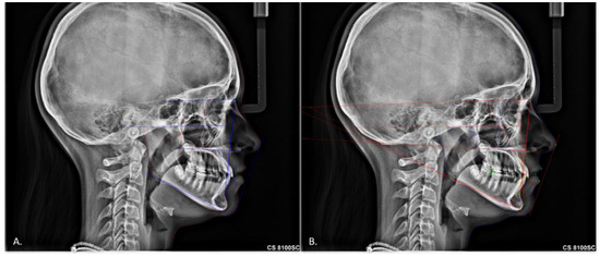 Comparing a Fully Automated Cephalometric Tracing Method to a Manual Tracing Method for ...