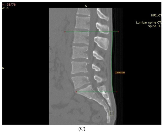 Schober Test and Its Modifications Revisited—What Are We Actually ...