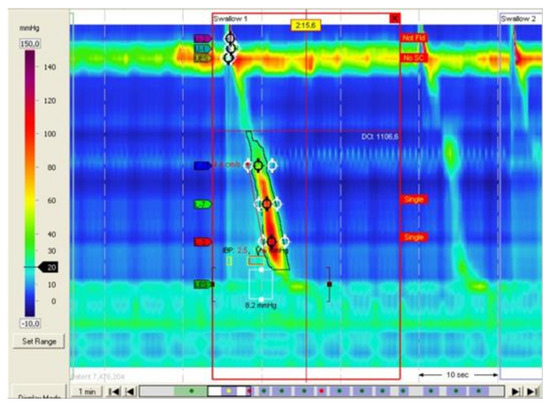 Identification of Sliding Hiatus Hernia by High-Resolution Manometry ...