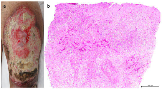Treatment Strategy for Pyoderma Gangrenosum: Skin Grafting with Immunosuppressive Drugs
