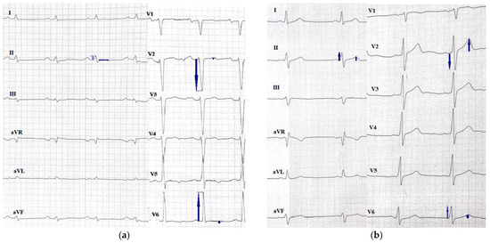 Electrocardiographic Parameters Associated with Adverse Outcomes in ...