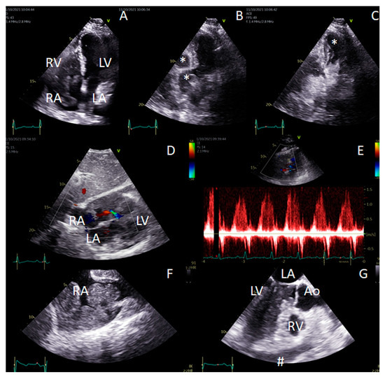 Cardiac Involvement in Chronic Lymphocytic Leukemia/Small Lymphocytic ...