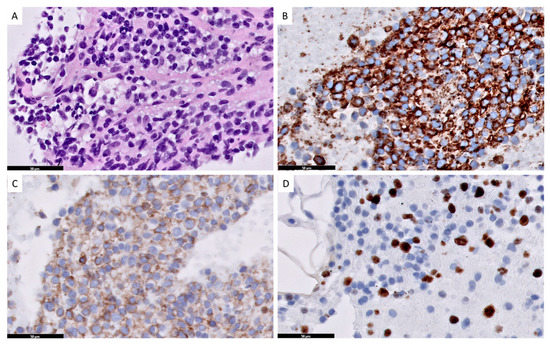 Cardiac Involvement in Chronic Lymphocytic Leukemia/Small Lymphocytic ...