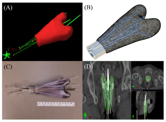 A Novel Workflow with a Customizable 3D Printed Vaginal Template and a ...