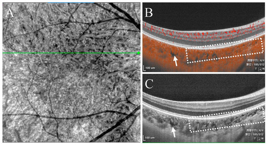 Characteristics and Classification of Choroidal Caverns in Patients ...