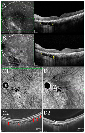 Characteristics and Classification of Choroidal Caverns in Patients ...