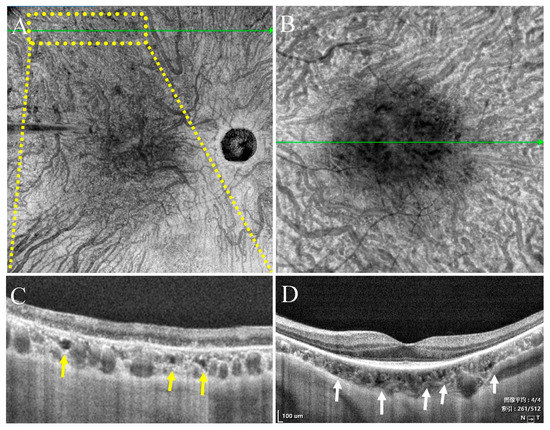 Characteristics and Classification of Choroidal Caverns in Patients ...