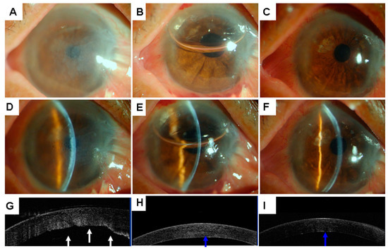 A Simple Repair Algorithm for Descemet’s Membrane Detachment Performed ...