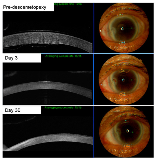 A Simple Repair Algorithm for Descemet’s Membrane Detachment Performed ...