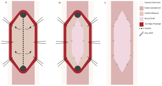 Non-Transecting Urethroplasty for Bulbar Urethral Strictures—Narrative ...