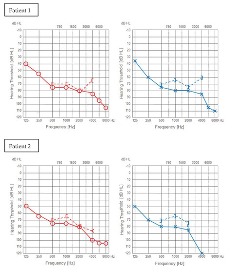 Robot-Assisted Electrode Insertion in Cochlear Implantation Controlled ...