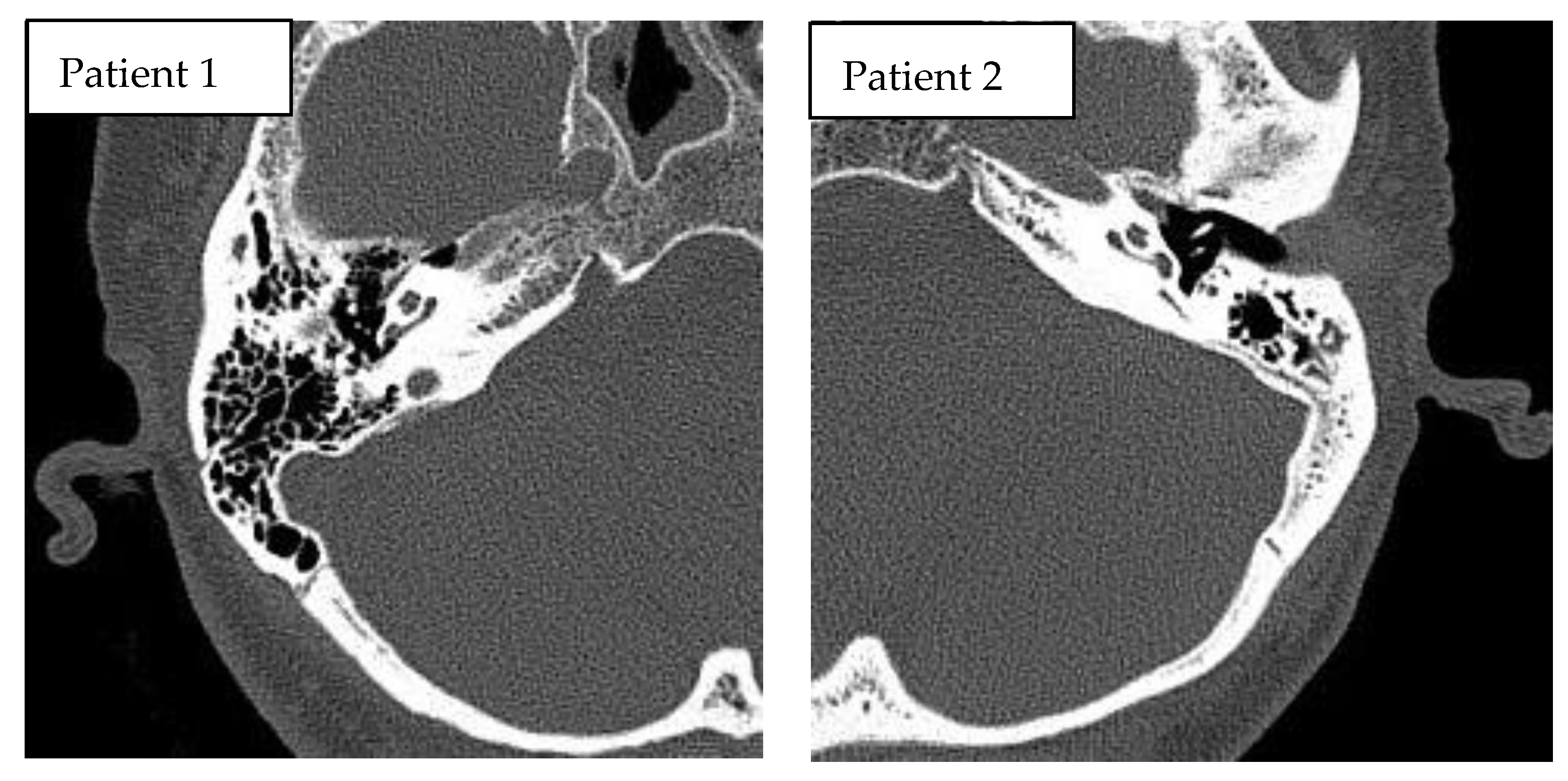 Robot-Assisted Electrode Insertion in Cochlear Implantation Controlled ...