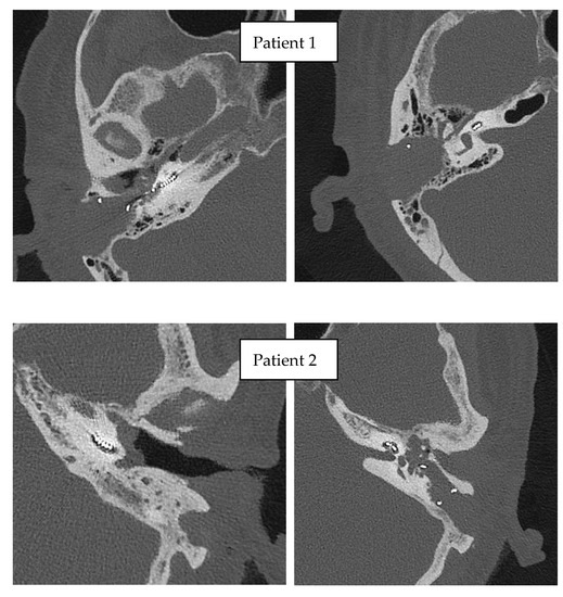 Robot-Assisted Electrode Insertion in Cochlear Implantation Controlled ...