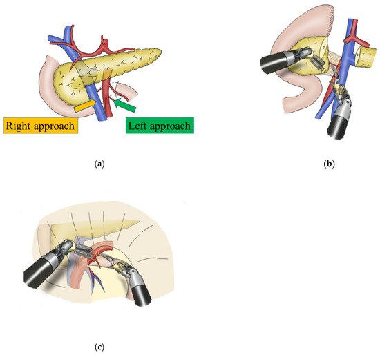 Surgical Strategies to Dissect around the Superior Mesenteric Artery in Robotic ...