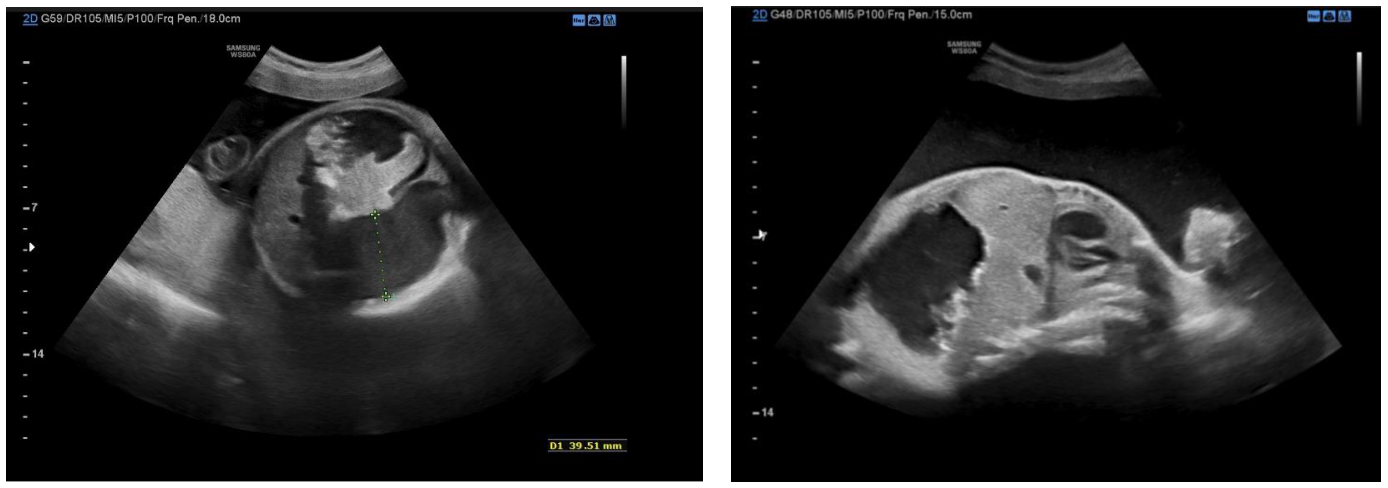 Jcm Free Full Text Case Series Of Acute Meconium Peritonitis