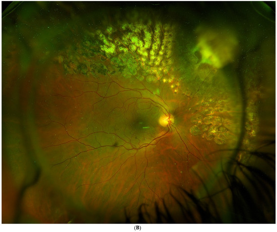 Local Resection in Choroidal Melanoma: A Review
