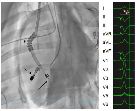 Conduction System Pacing Today and Tomorrow