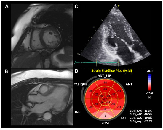 Chagas Heart Disease: Beyond a Single Complication, from Asymptomatic ...