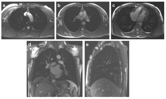 Characteristics of Diaphragmatic and Chest Wall Motion in People with ...