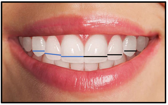 The Analysis of Facio-Dental Proportions to Determine the Width of ...