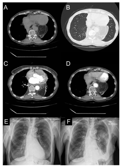 Clinicopathological Features of Intrathoracic Liposarcoma—A Systematic Review with an ...