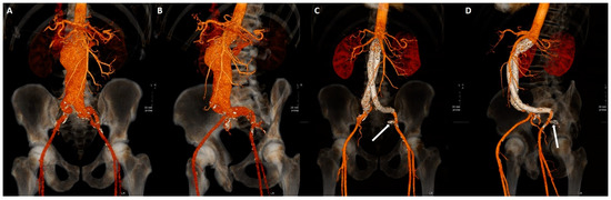 Internal Iliac Artery Embolization within EVAR Procedure: Safety ...