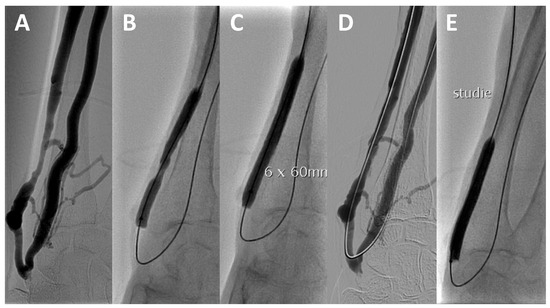 Angioplasty of Dysfunctional Dialysis Fistula or Graft with Resveratrol ...