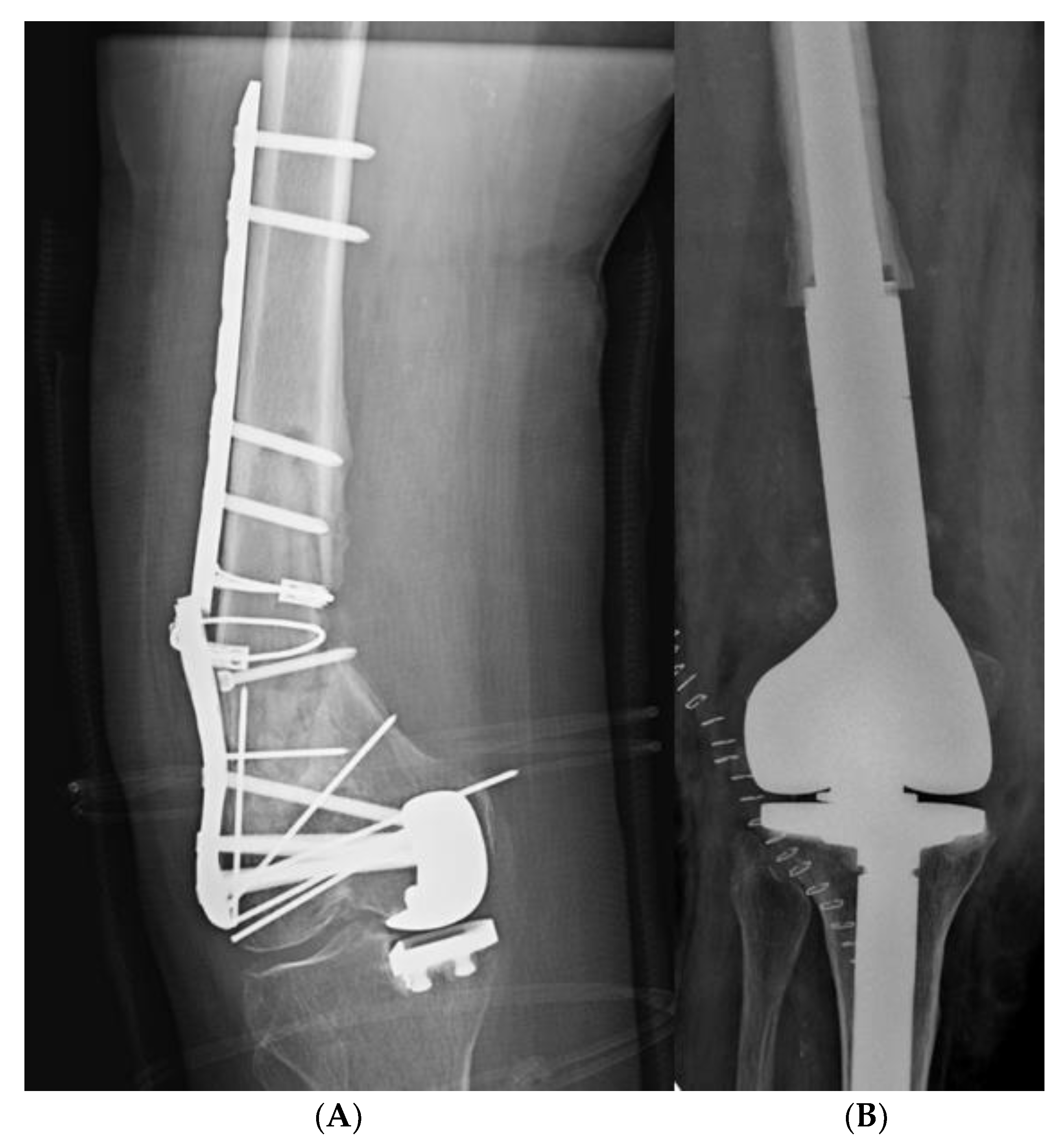 Treatment of Femoral Shaft Pseudarthrosis, Case Series and Medico-Legal ...