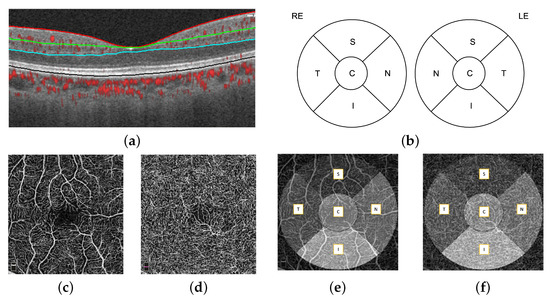 Detection of Stroke with Retinal Microvascular Density and Self-Supervised Learning Using OCT-A ...