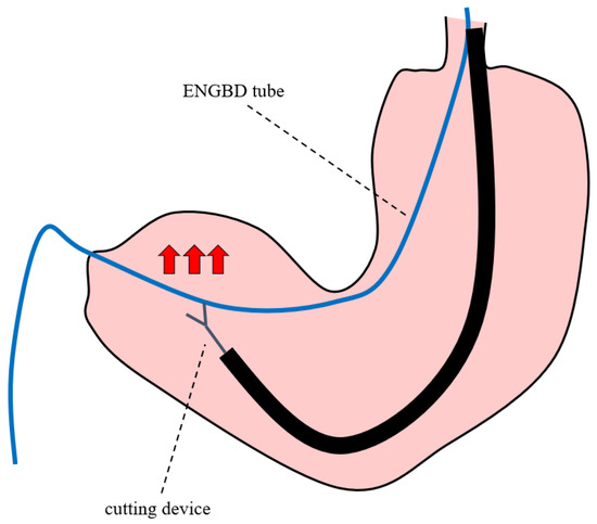 Endoscopic Internalization by Cutting the Endoscopic Transpapillary ...