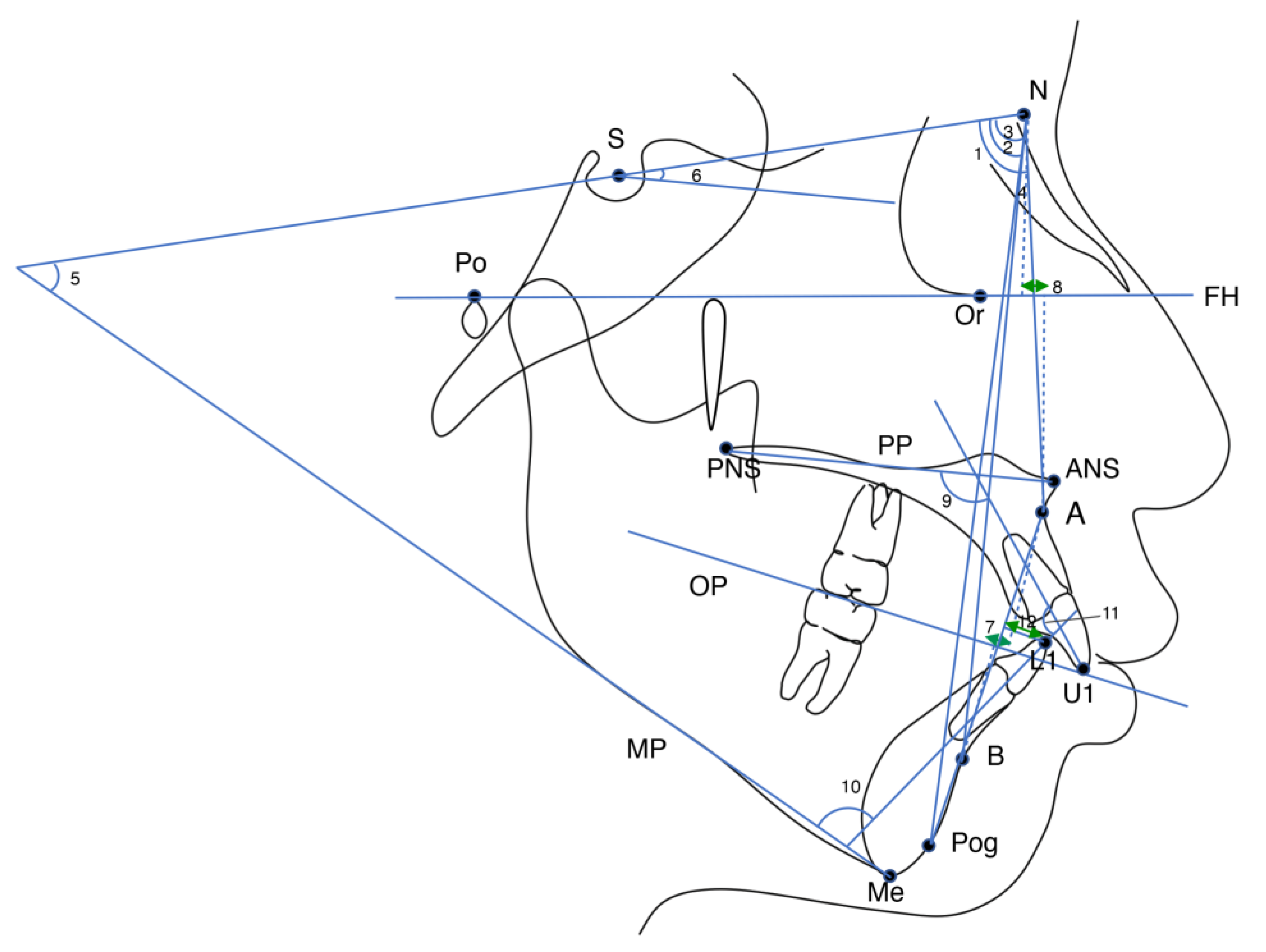 Effects of Two-Phase Treatment with Functional Appliances Followed by ...