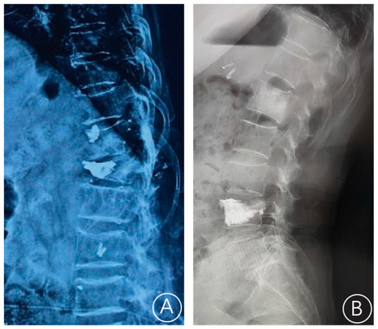 Predictive Factors for Bone Cement Displacement following Percutaneous ...
