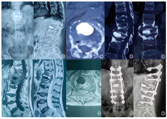 Predictive Factors for Bone Cement Displacement following Percutaneous ...