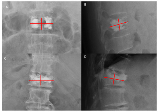 Incidence, Risk Factors, and Outcomes of Symptomatic Bone Cement ...
