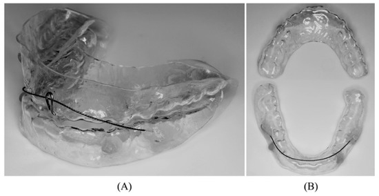Dental and Occlusal Changes during Mandibular Advancement Device ...