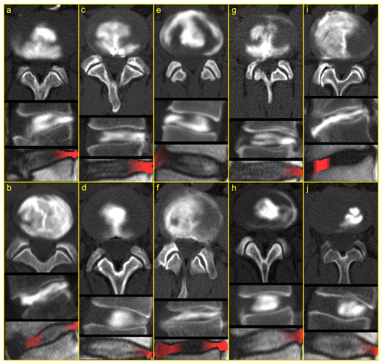 Detection of Imperceptible Intervertebral Disc Fissures in Conventional ...