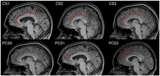 Morphology of Anterior Cingulate Cortex and Its Relation to Schizophrenia