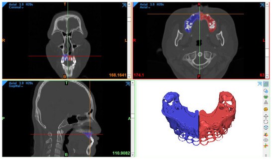 The Concordance of Alveolar Bone Deficiency with Severity of Lip ...