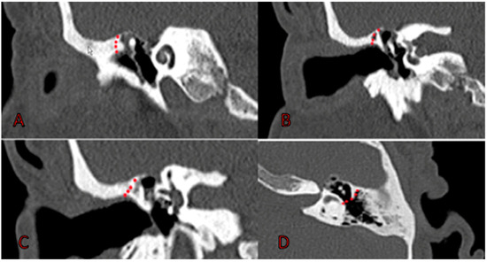 Effectiveness and Safety of Attic Exposition–Antrum Exclusion versus ...