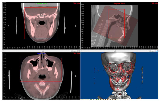 Automatic Masseter Muscle Accurate Segmentation from CBCT Using Deep Learning-Based Model