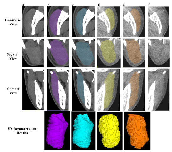 Automatic Masseter Muscle Accurate Segmentation from CBCT Using Deep ...