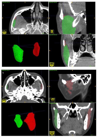 Automatic Masseter Muscle Accurate Segmentation from CBCT Using Deep Learning-Based Model