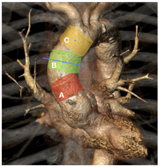 Dynamic Morphology of the Ascending Aorta and Its Implications for ...