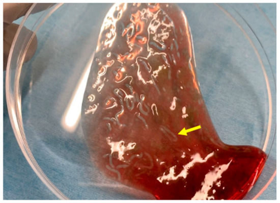 Comparison of Endoscopic Hemostasis for Endoscopic Sphincterotomy ...