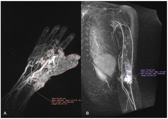 The Usefulness of MRI Dynamic Flow Sequences in Differentiating High ...