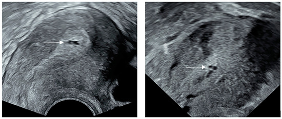 The Cystic Anechoic Zone of Uterine Cavity Newly Observed during ...
