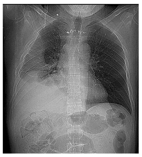 Which Surgery for Stage II–III Empyema Patients? Observational Single ...