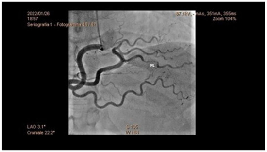 Multimodality Imaging Approach to Spontaneous Coronary Artery Dissection