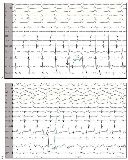 Not Just a One-Way: Mahaim Accessory Pathway Concomitantly Supporting ...